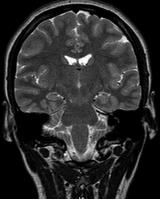 HIPPOCAMPAL-MALROTATION-AND-ITS-RELATION-TO-TEMPORAL-LOBE-EPILEPSY--A ...
