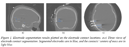 Automated-Visualization-of-Ictal-and-Interictal-SEEG-Activity-to ...