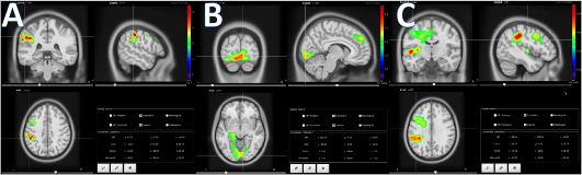 Low-Sensor-Count-OPM-MEG-Imaging-of-Electrophysiological-Sources ...